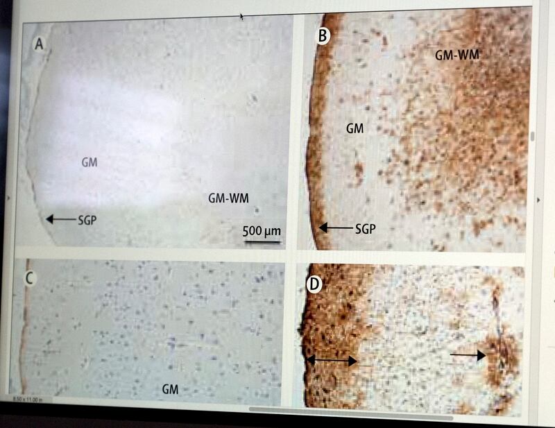 Navy SEAL’s family pushes for recognition of brain injuries